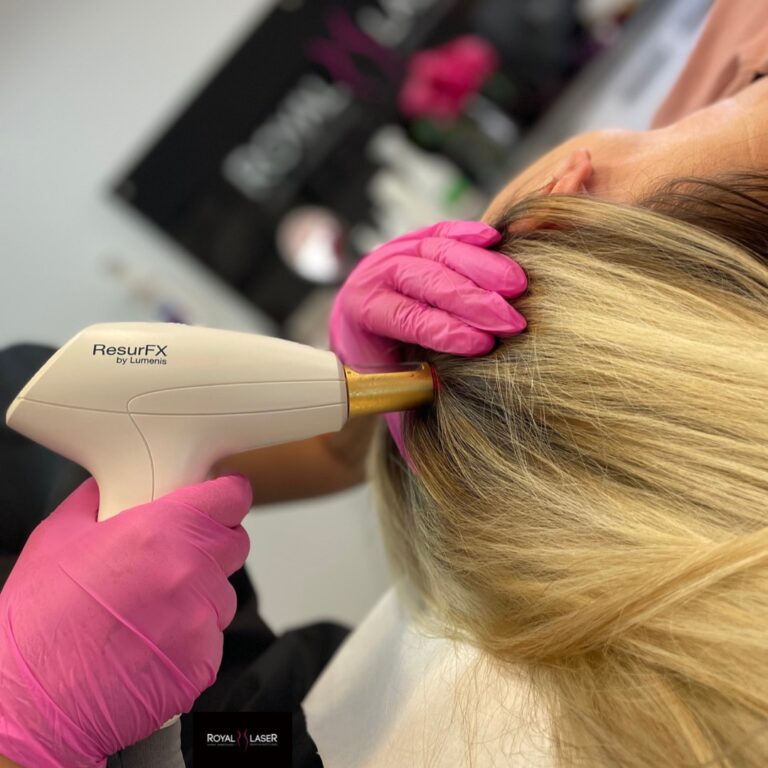 Laserowa stymulacja wzrostu włosów– innowacja w terapii wypadania ...
